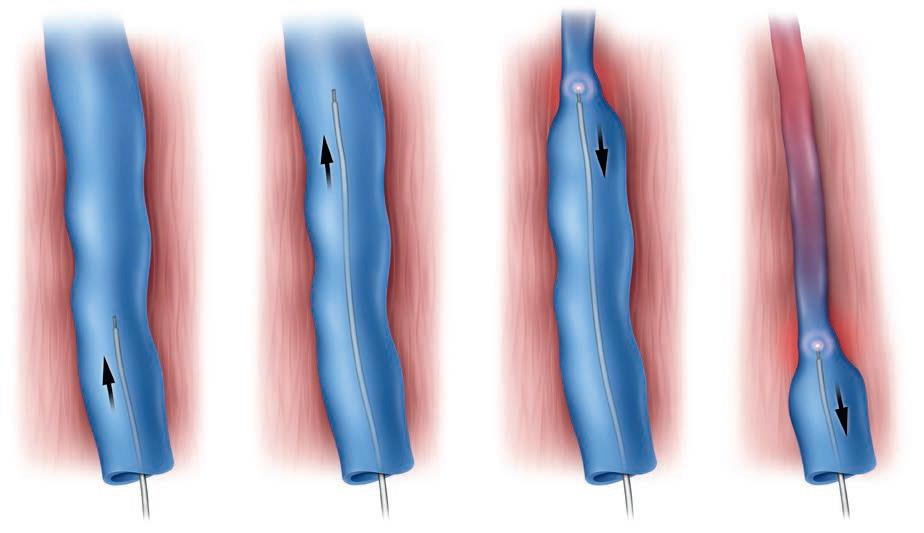 De behandeling | Spatadervrij
